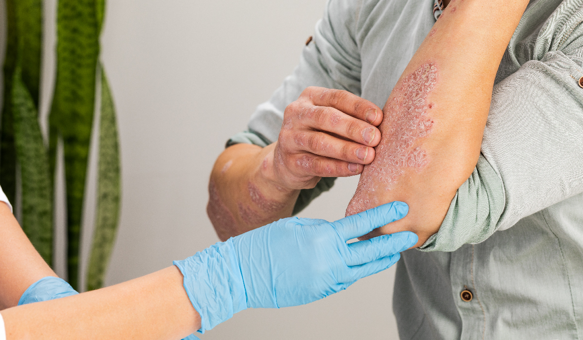 PSORIAHUE - Medicina para la Piel + Estética / PSORIASIS